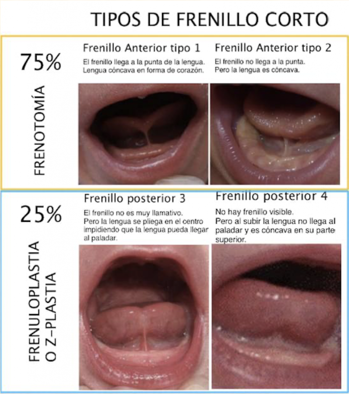 Frenillo lingual y logopedia - PSICOSOL